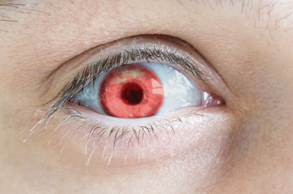 Bilder Von Augenalbinismus