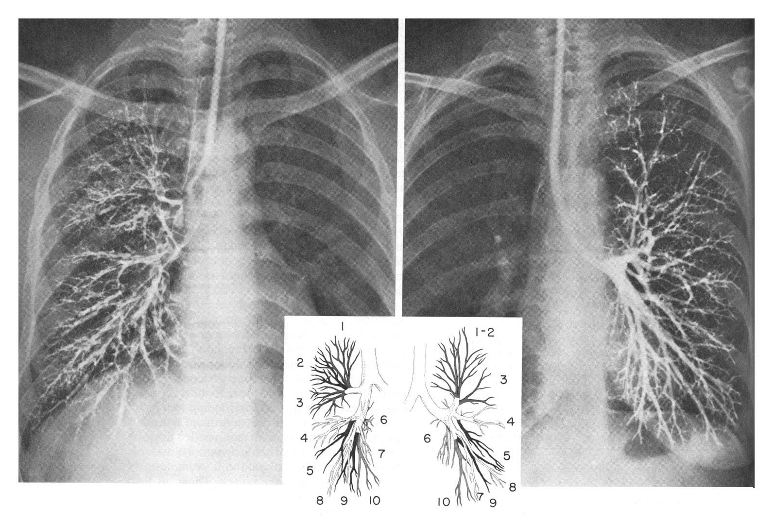 Figure From A Technique Of Bronchography In Children With, 43% OFF