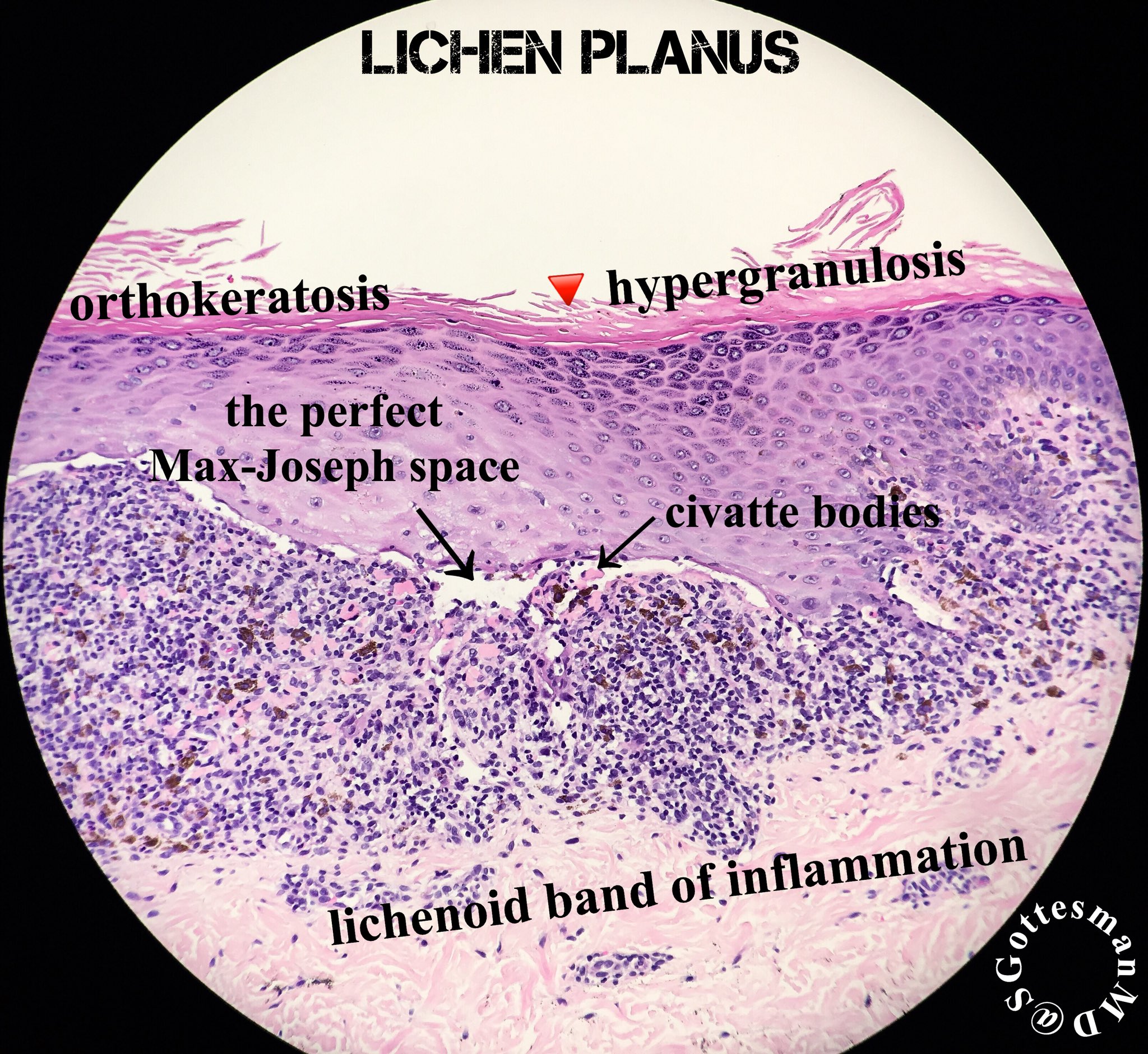 Lichen Planopilaris Histology Scarring Alopecia | Actas
