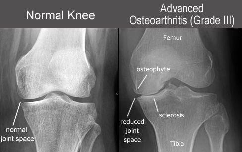 Subchondral Cyst