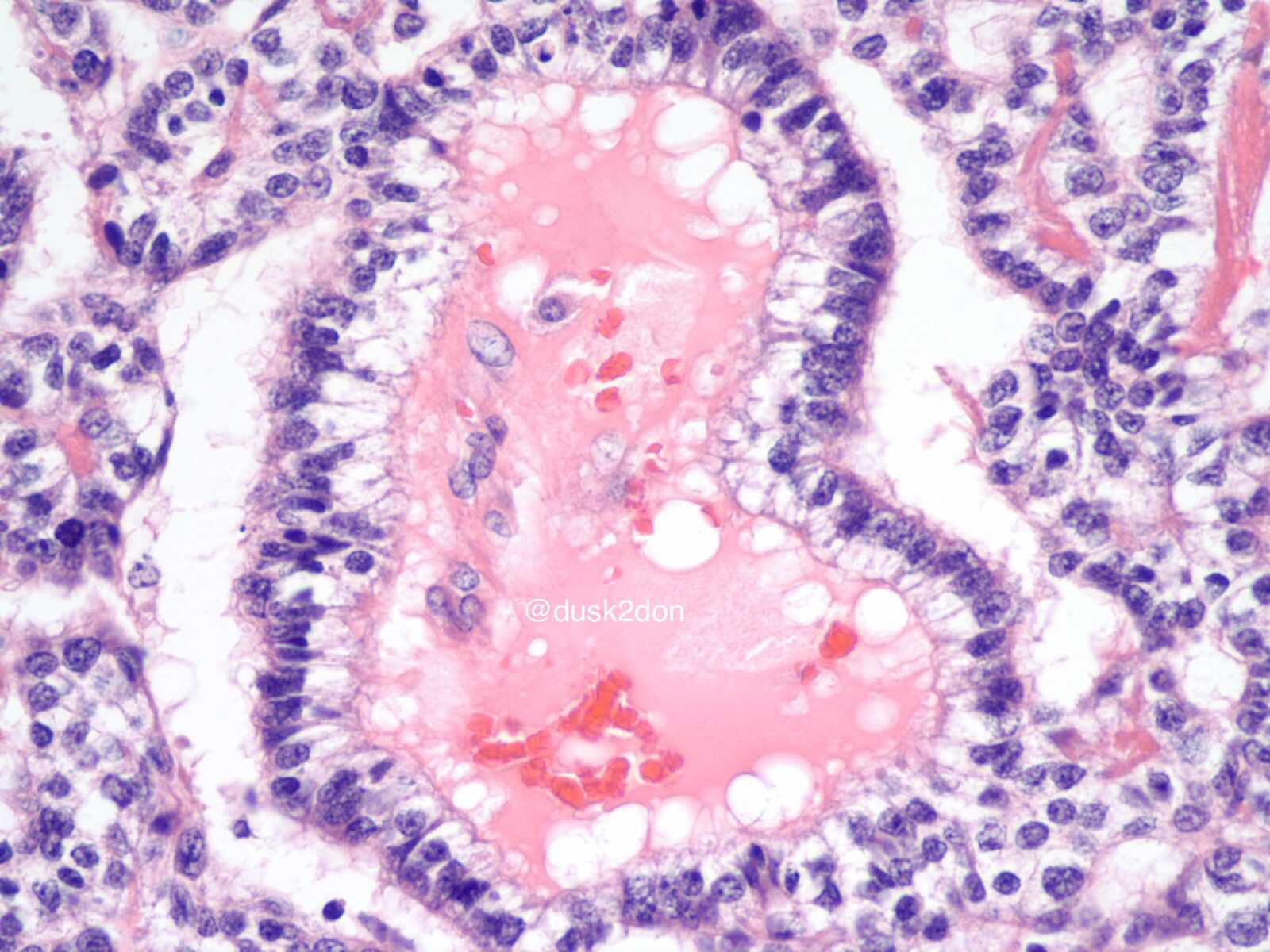 Yolk Sac Tumor Schiller Duval Bodies