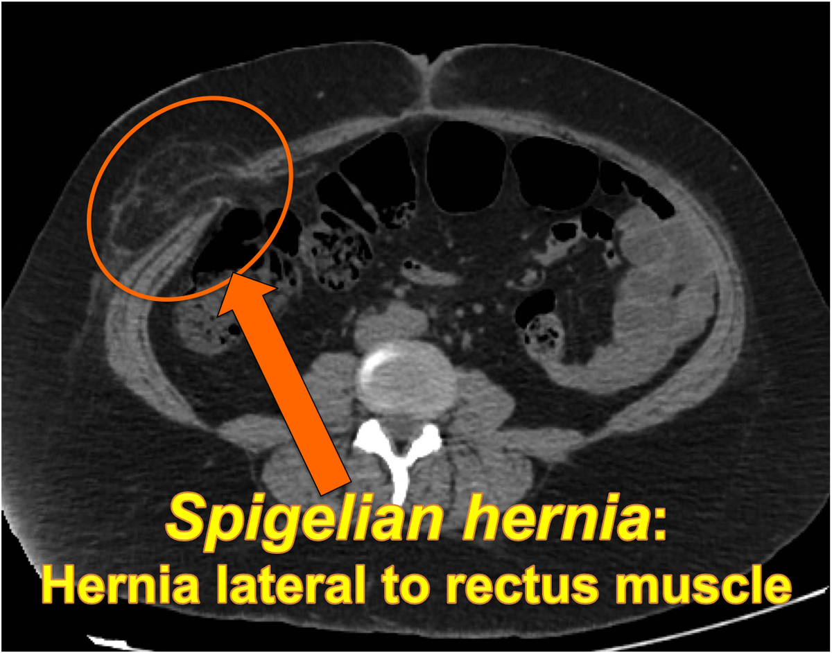 Spigelian Hernia Radiology