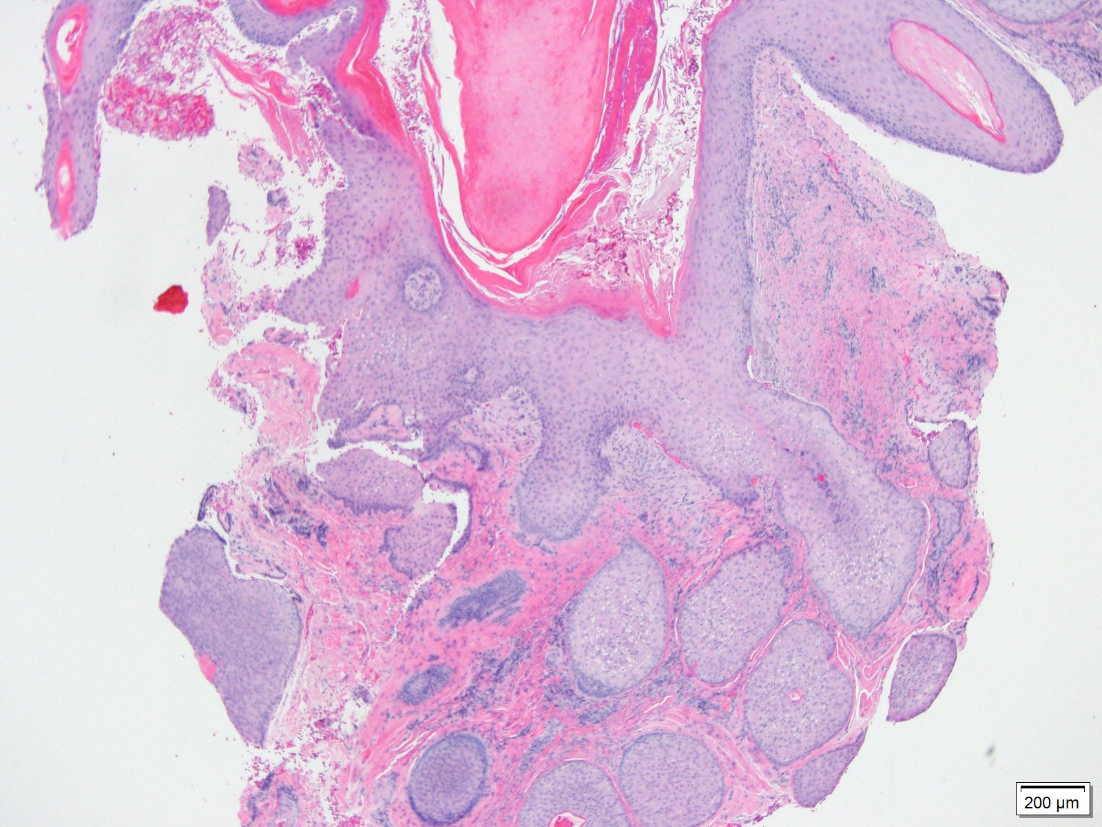 Pilar Sheath Acanthoma