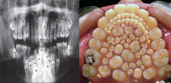 Hyperdontia Causes