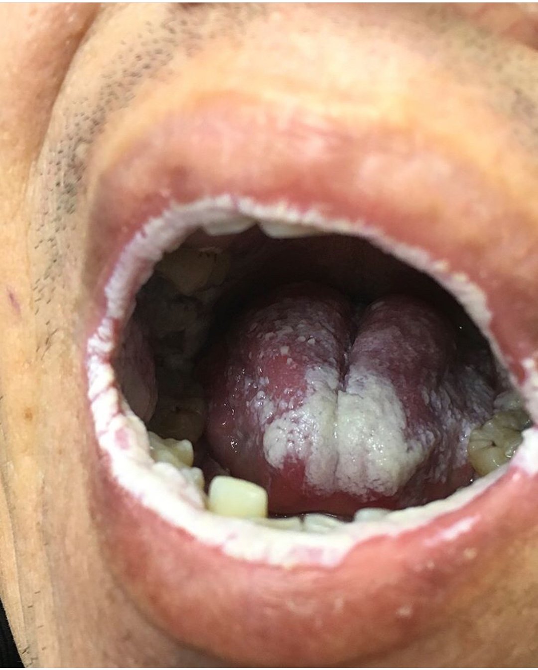 Oral Thrush Hiv