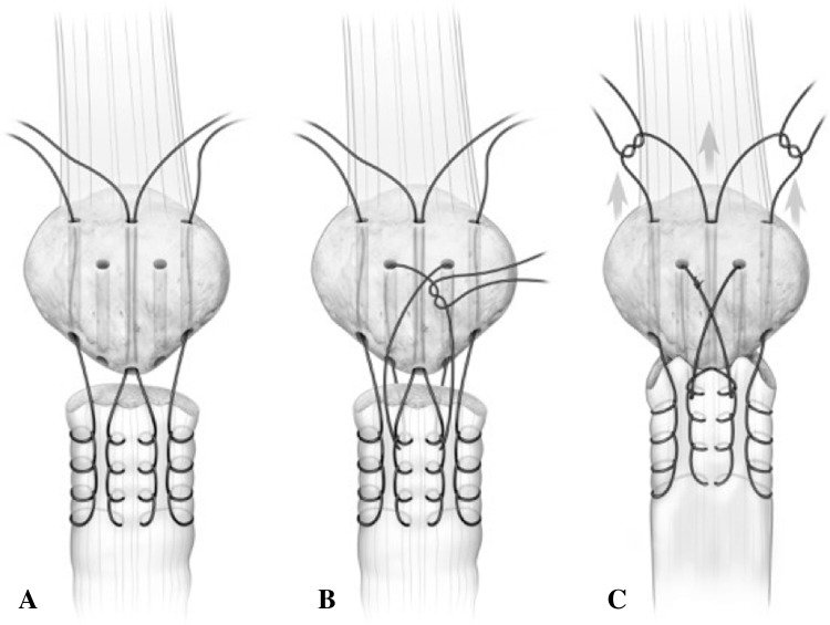 Patellar Tendon Repair