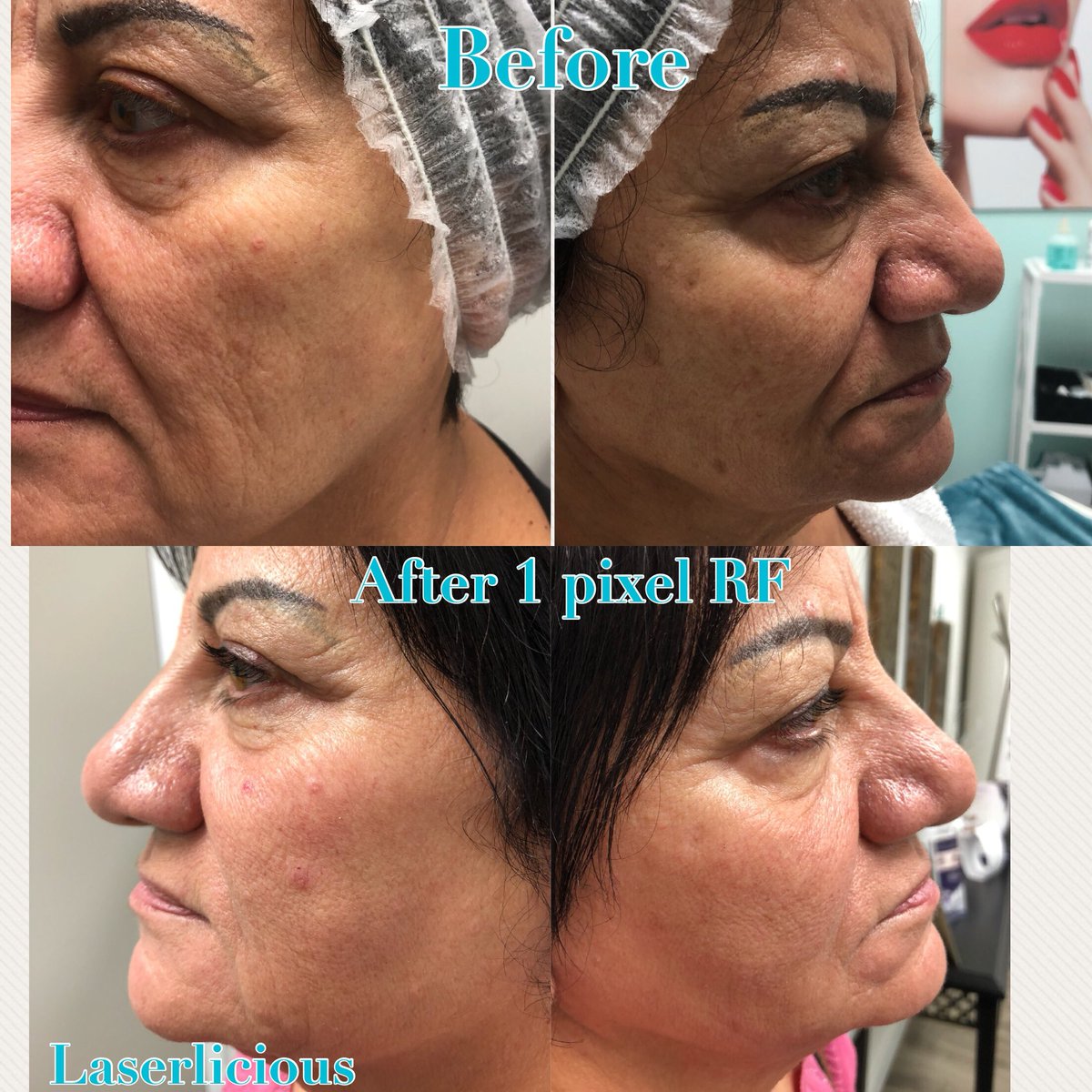 Pixel Laser After Treatment