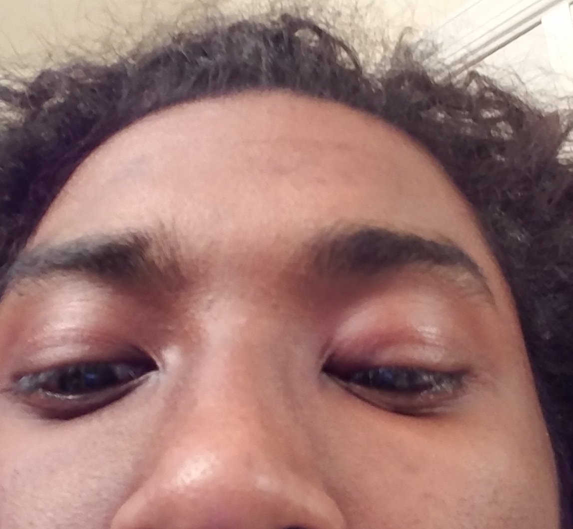 Bee Sting Eyelid