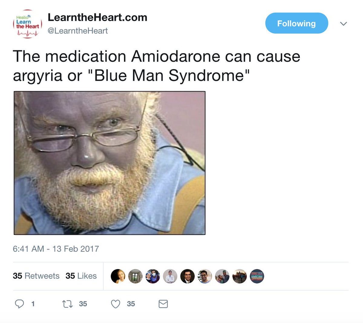 Argyria Paul Karason