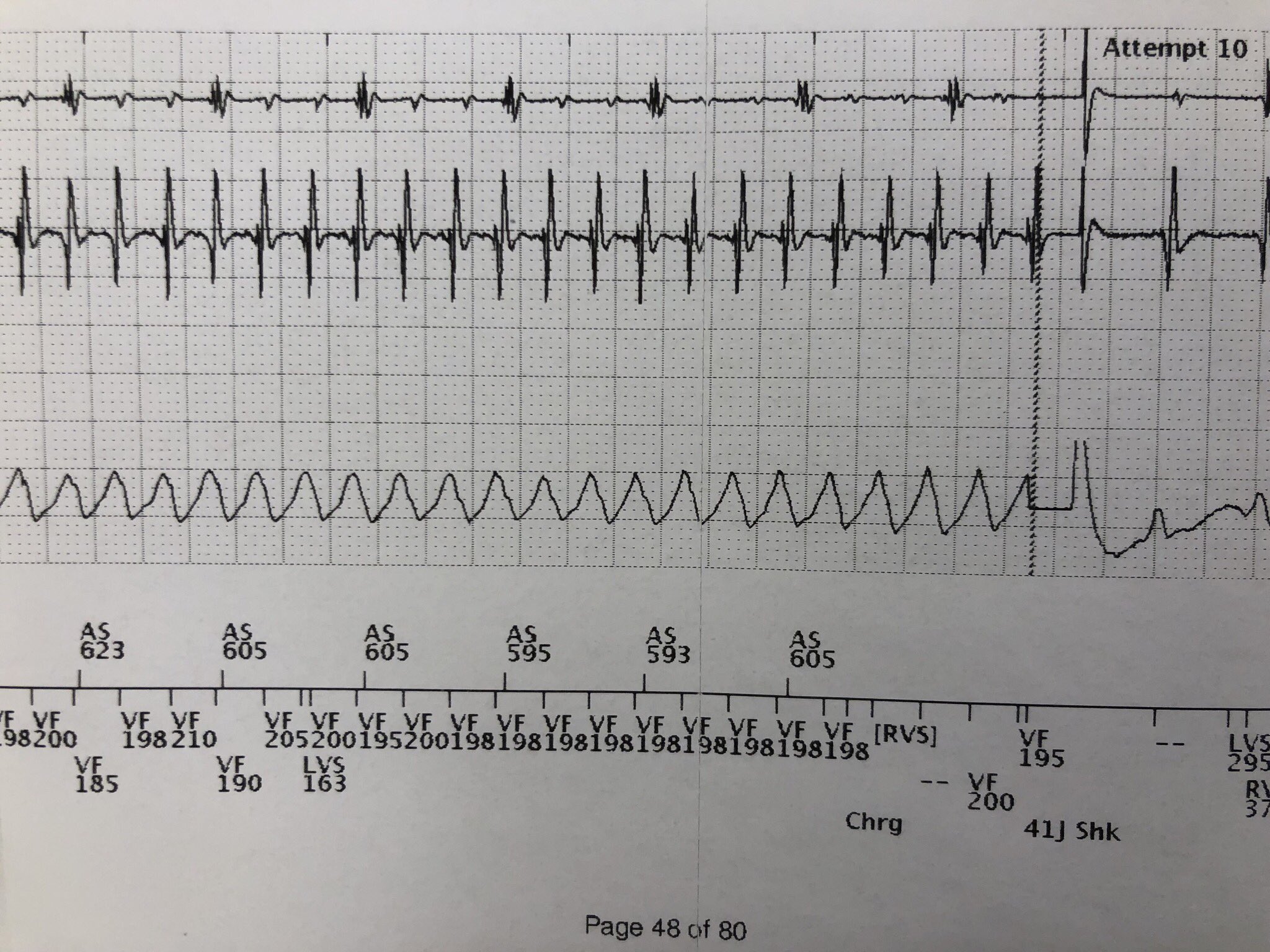 Ventricular Flutter