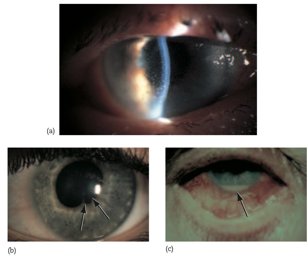 Anterior Vs Posterior Synechiae