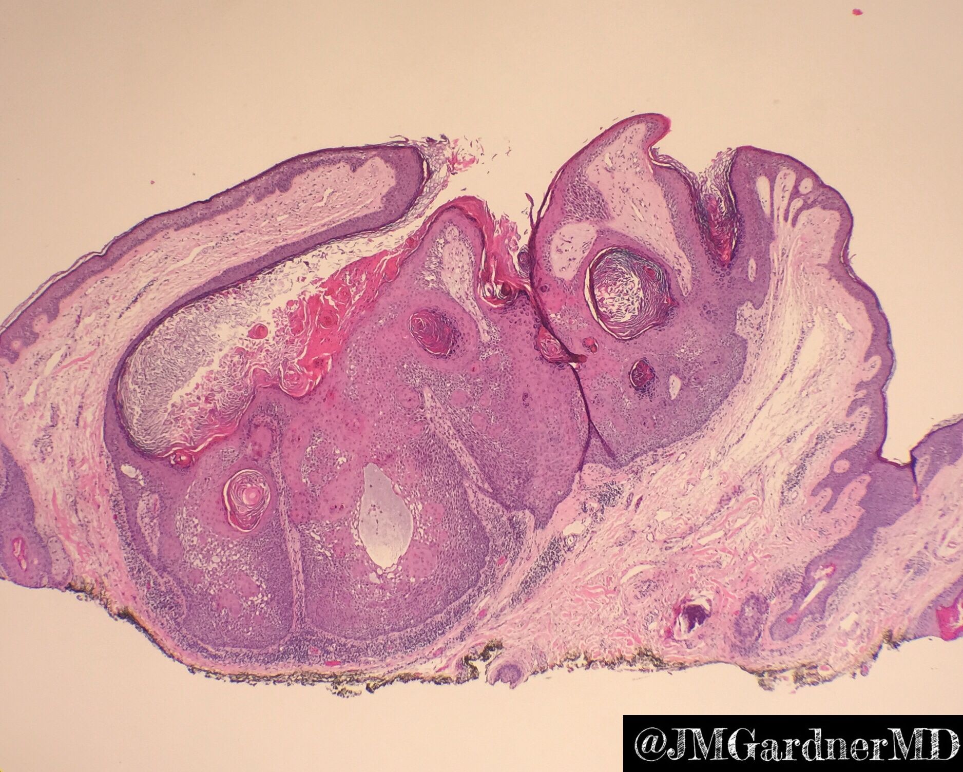 Inverted Follicular Keratosis Foot