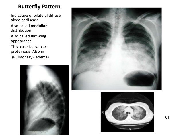 Pulmonary Edema X Ray Butterfly Pattern