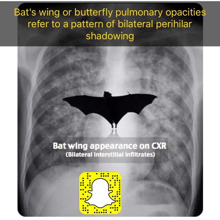 Pulmonary Edema X Ray Butterfly Pattern
