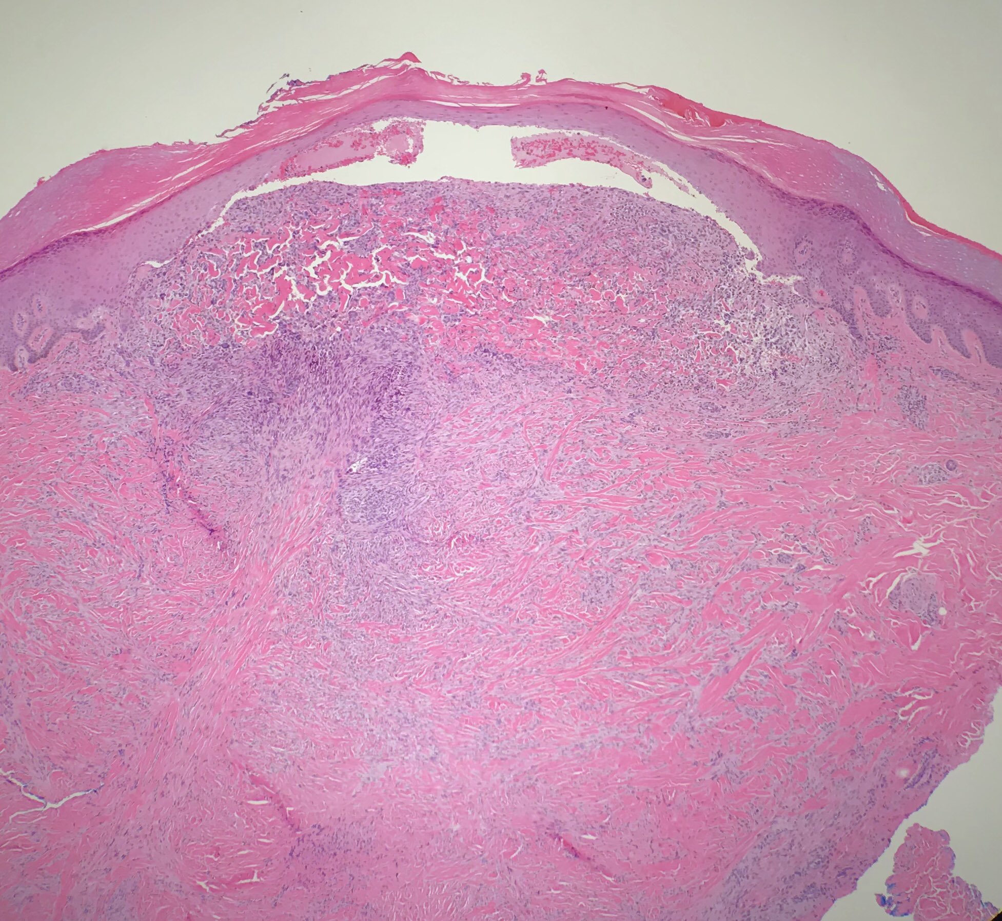 Dermatofibroma Histology Dermatofibroma: Sonographic Findings And