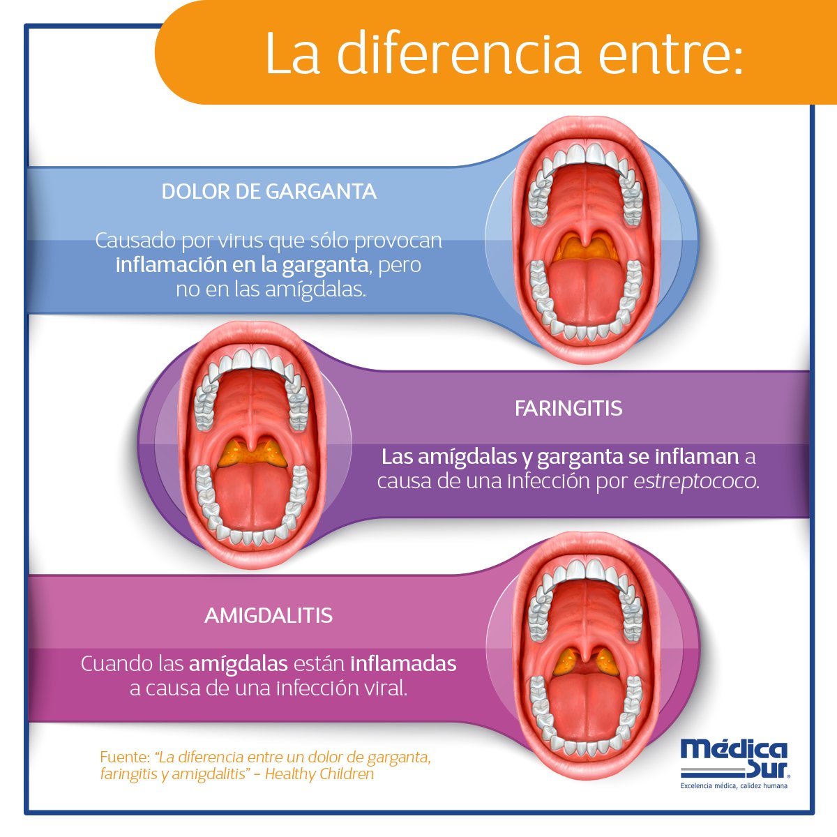 Faringitis Estreptocócica Versus Amigdalitis Recomendaciones Para El