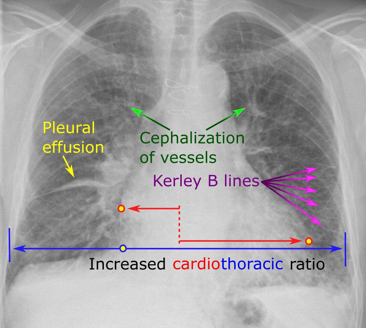 Peribronchial Cuffing