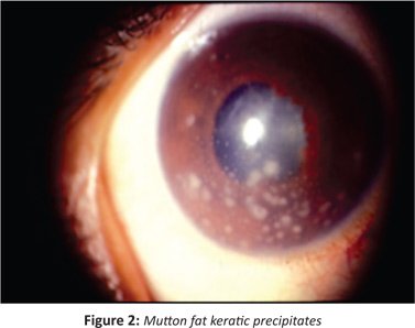 Mutton Fat Keratic Precipitates