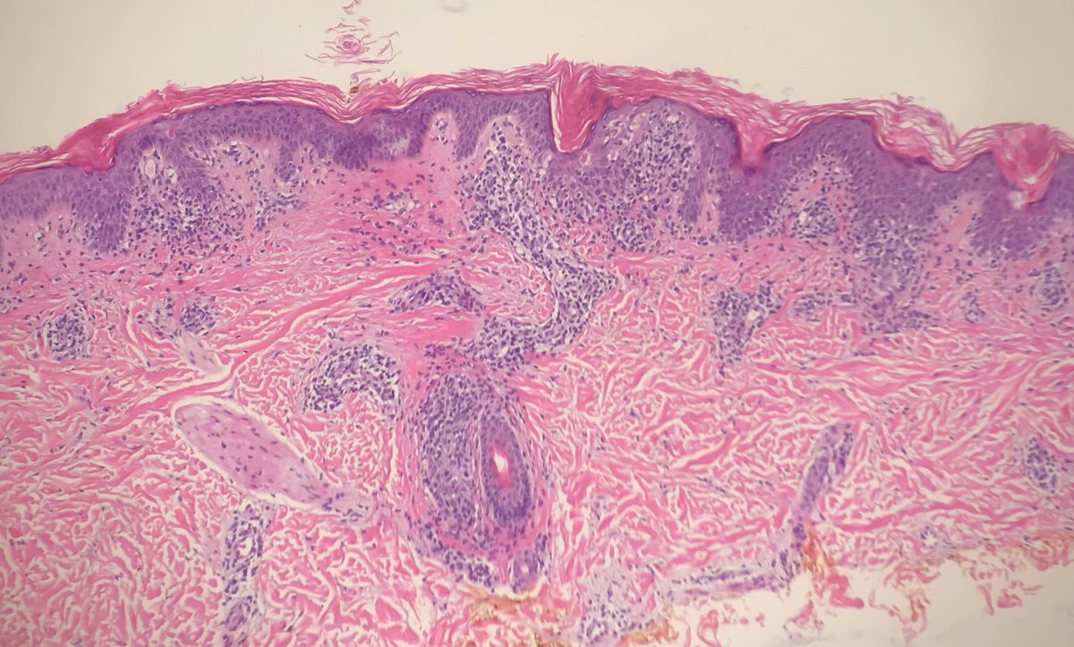 Lichen Striatus Histology