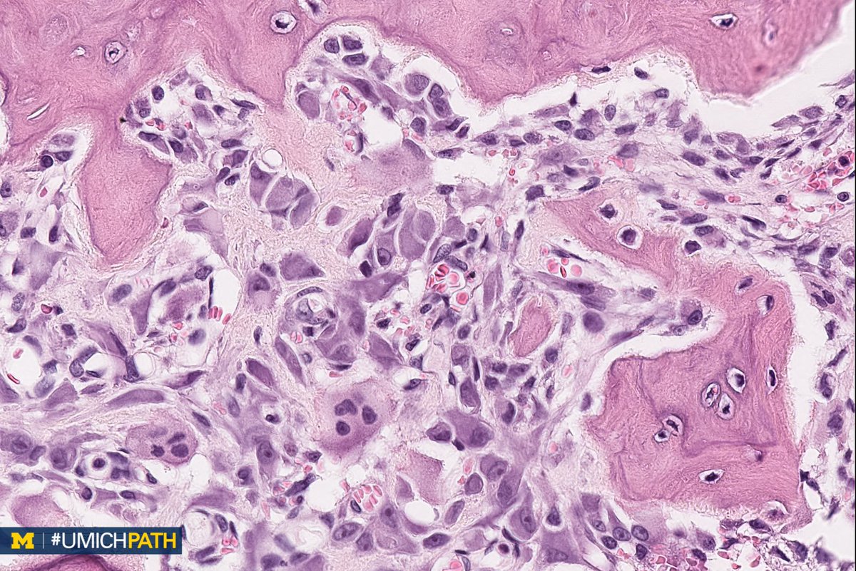 Osteoblastoma Pathology Outlines Pathology Outlines Osteosarcoma