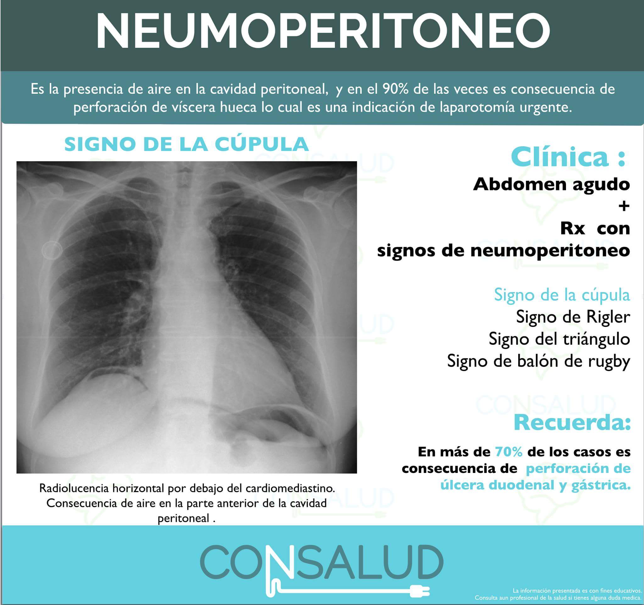 Signos Radiologicos Del Neumoperitoneo