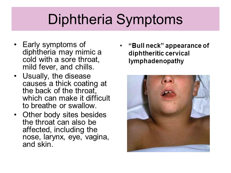 Diphtheria Bull Neck