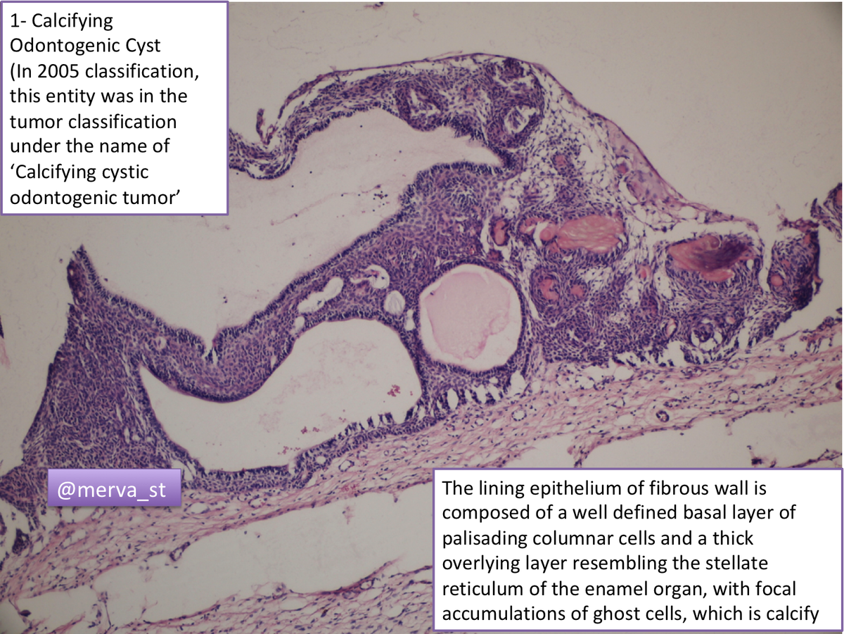 Ghost Cells Calcifying Odontogenic Cyst
