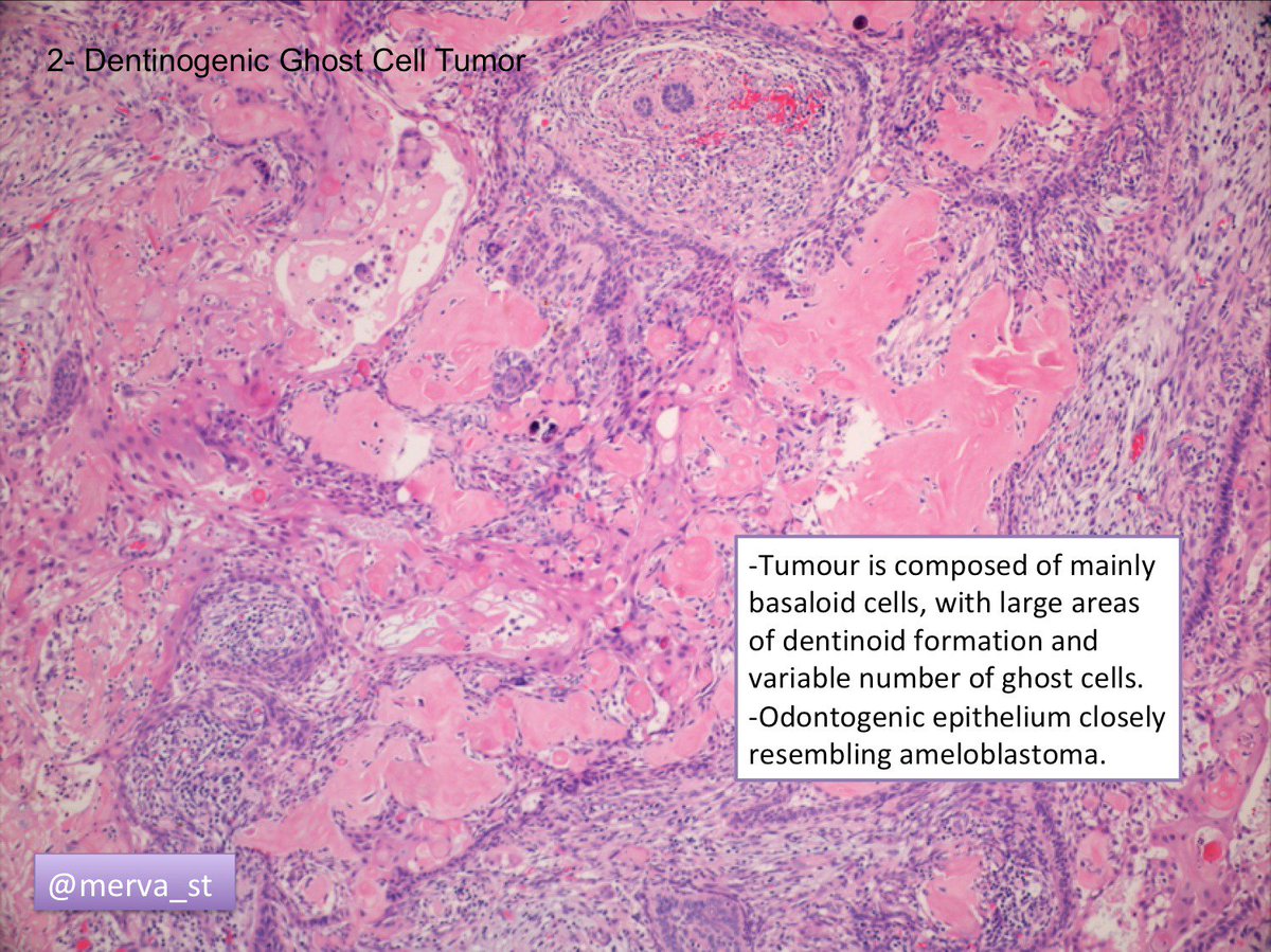Ghost Cells Calcifying Odontogenic Cyst American Journal Of Case