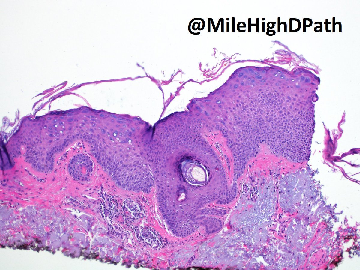 Epidermodysplasia Verruciformis Histologi Epidermodysplasia