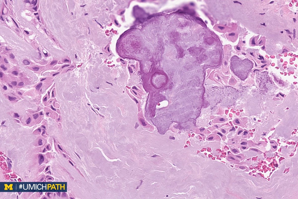 Calcifying Epithelial Odontogenic Tumor Histology