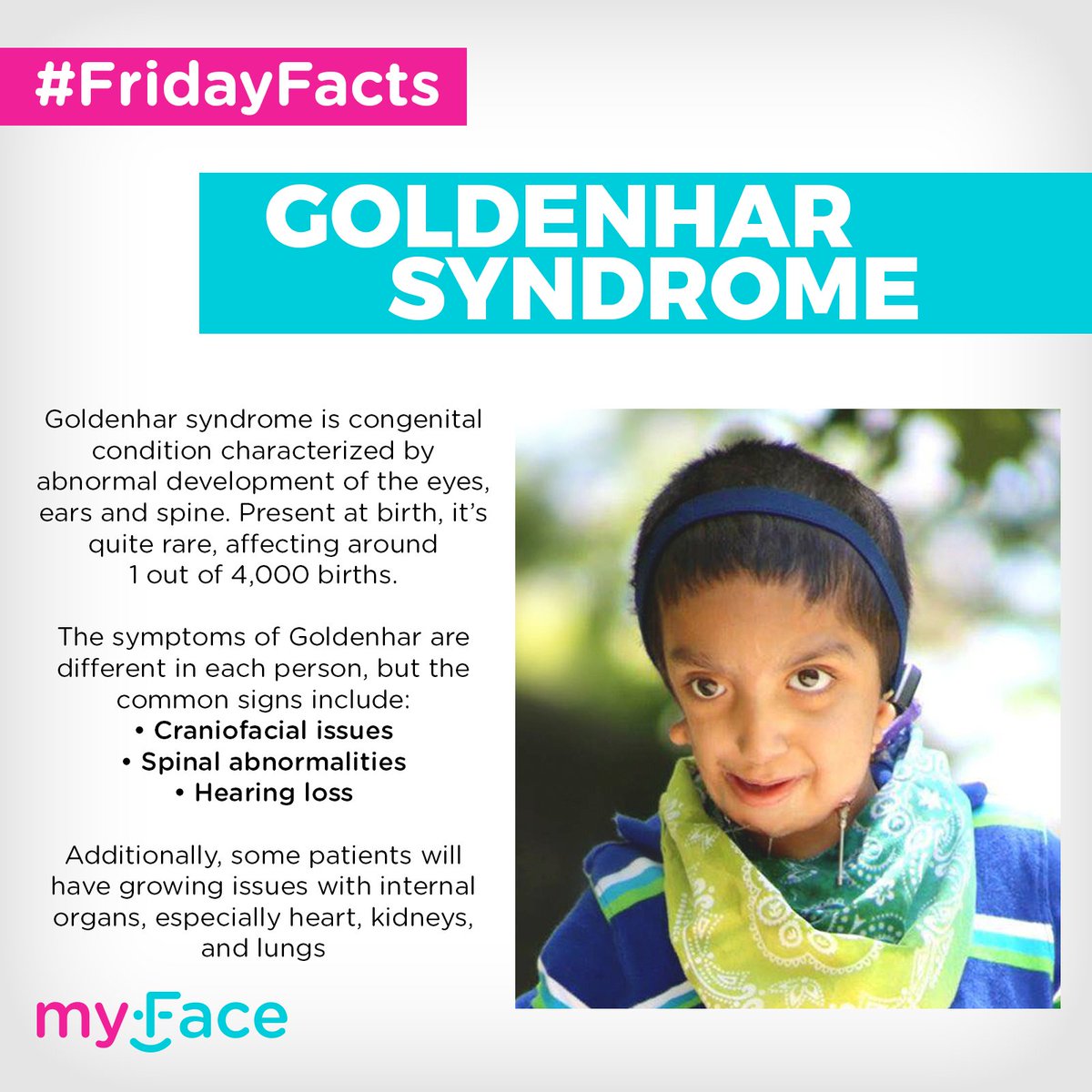 Goldenhar Disease Infant With Facial Anomalies | Consultant360