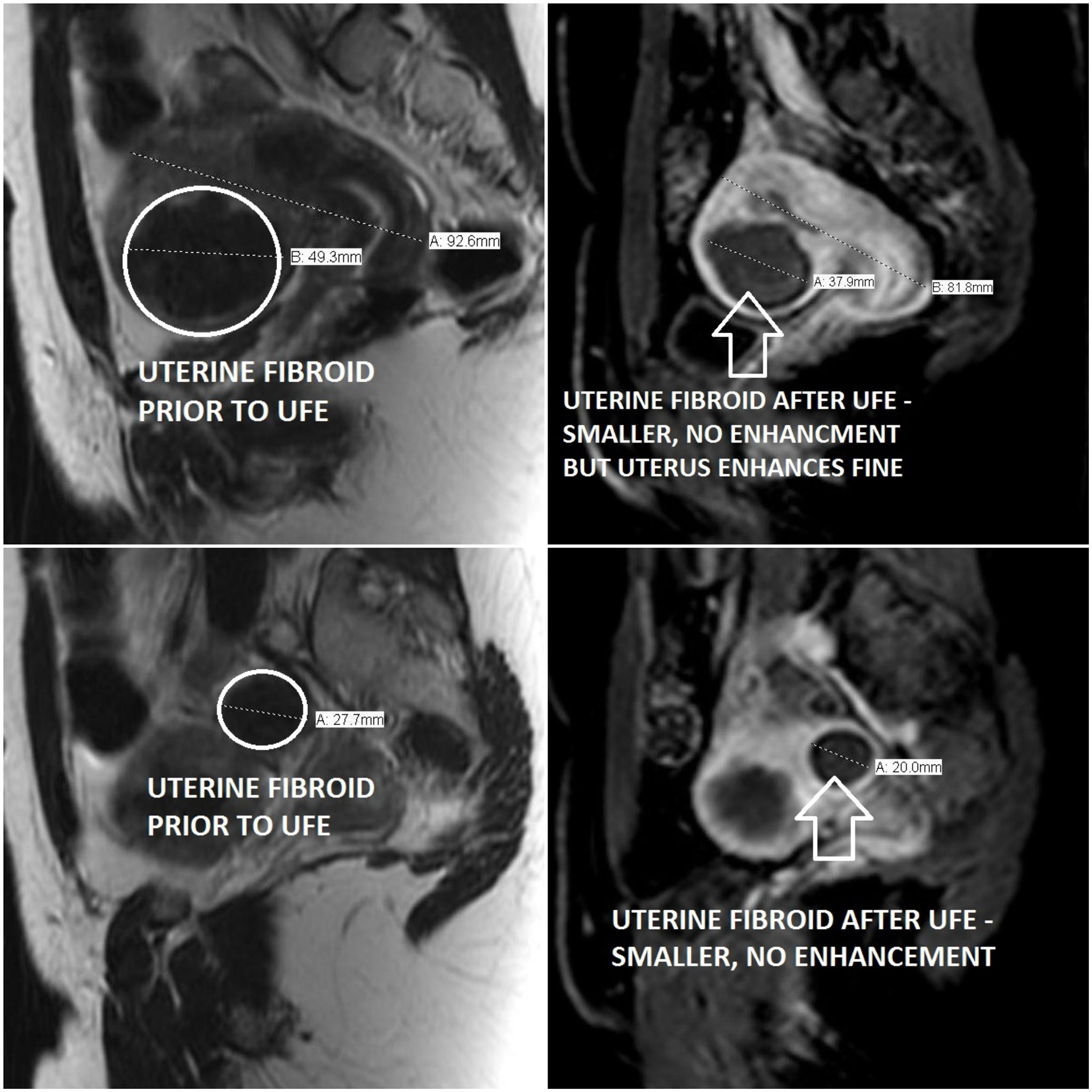 Uterine Fibroids Mri