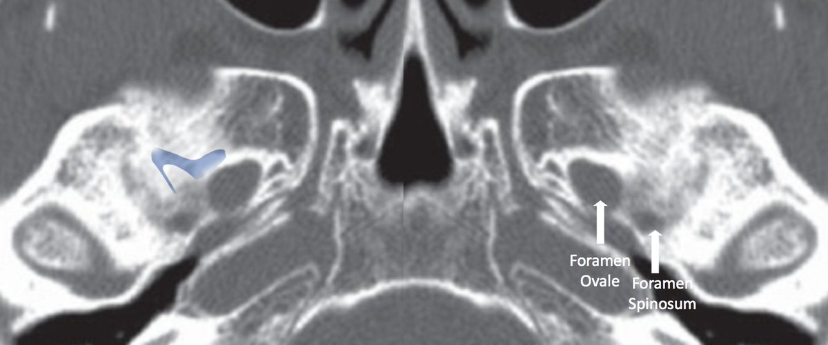 Foramen Rotundum And Ovale Radiology