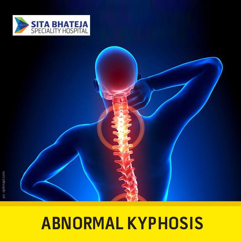 Upper Thoracic Kyphosis