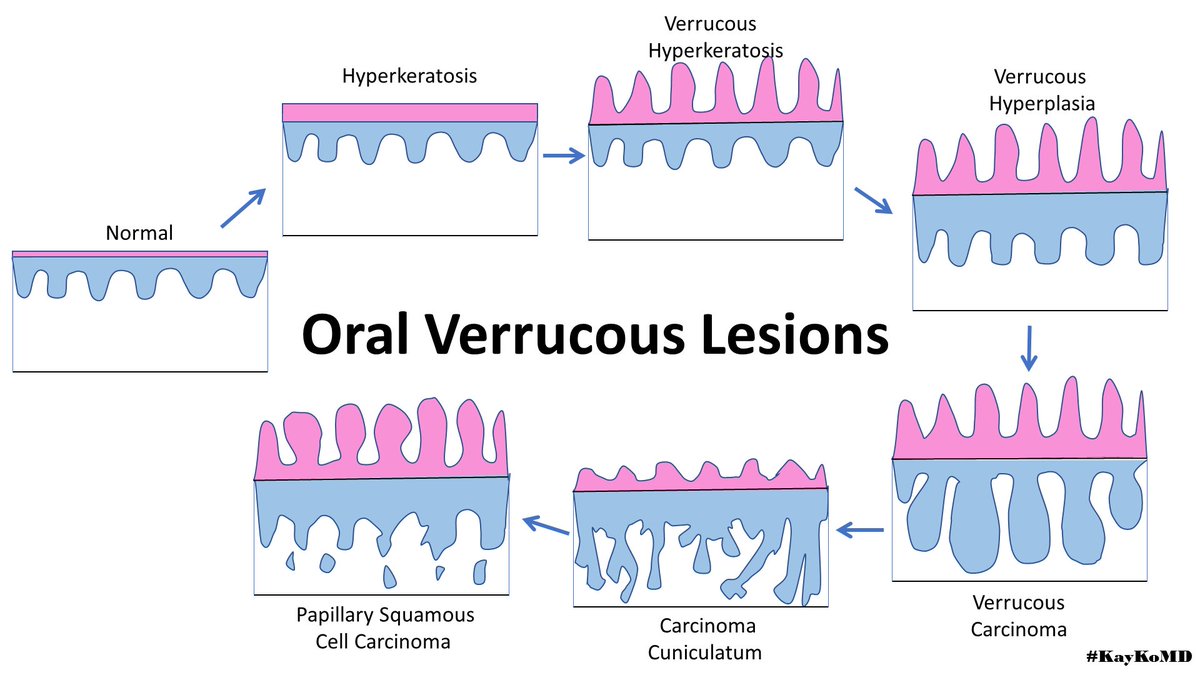Verrucous Leukoplakia