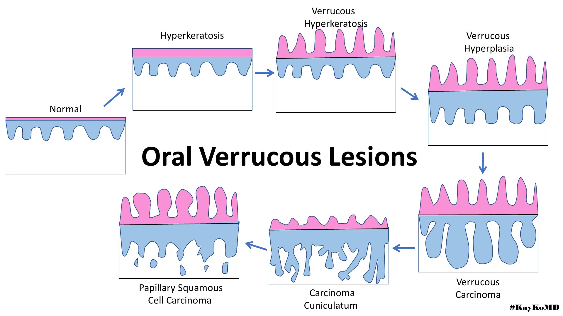 Proliferative Verrucous Leukoplakia Histology