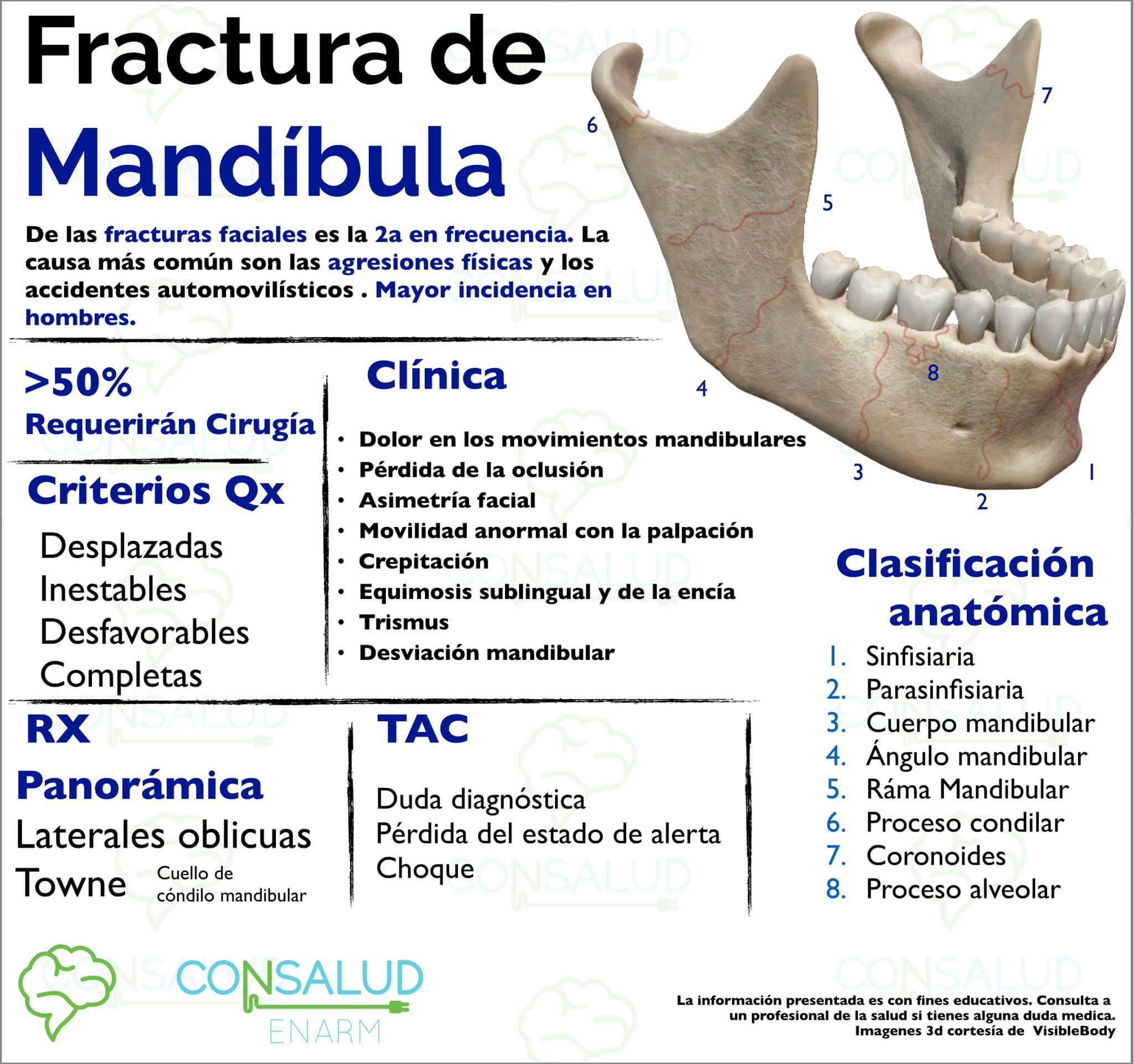 Clasificación De Fractura De Mandíbula