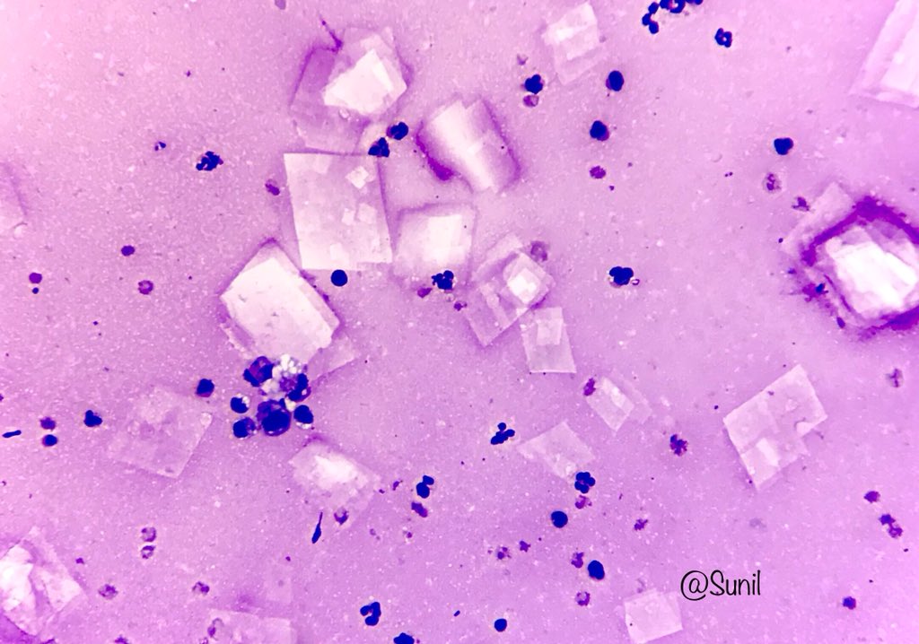Cholesterol Crystals