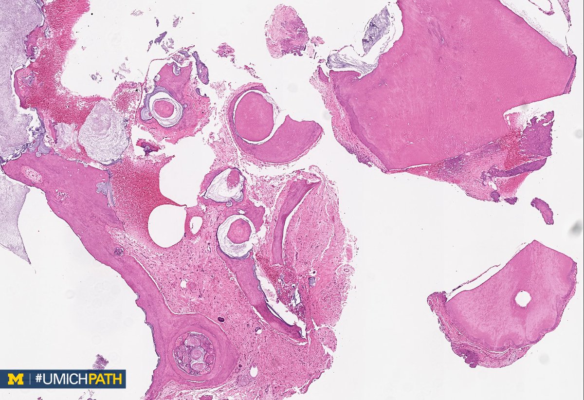 Chokes Pathology at Amelie Woolley blog