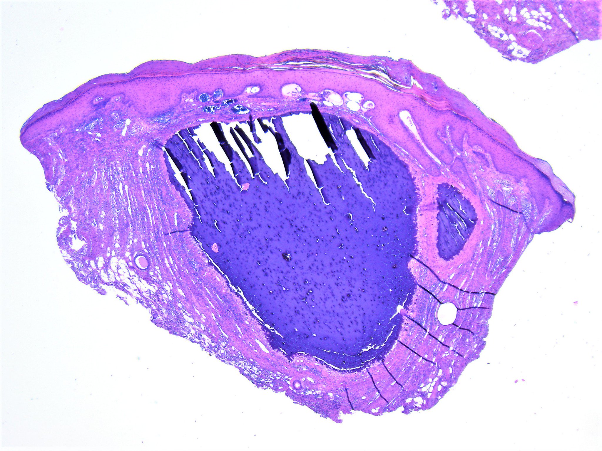 Calcinosis Cutis Histopathology