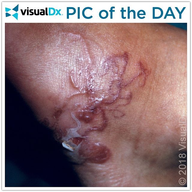 Sandworm Under The Skin