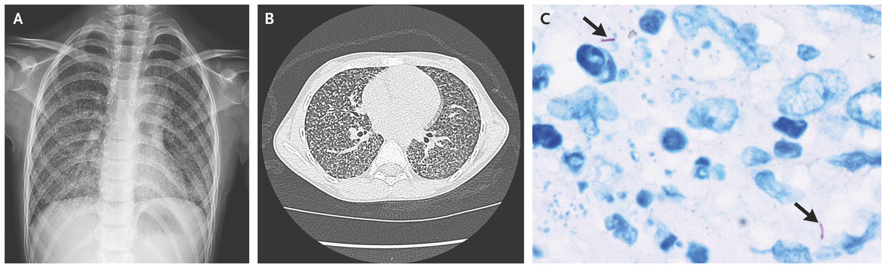 Miliary Tuberculosis