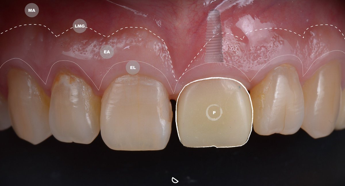 Encia Libre Y Encia Adherida - Citas Adultos En Zaragoza