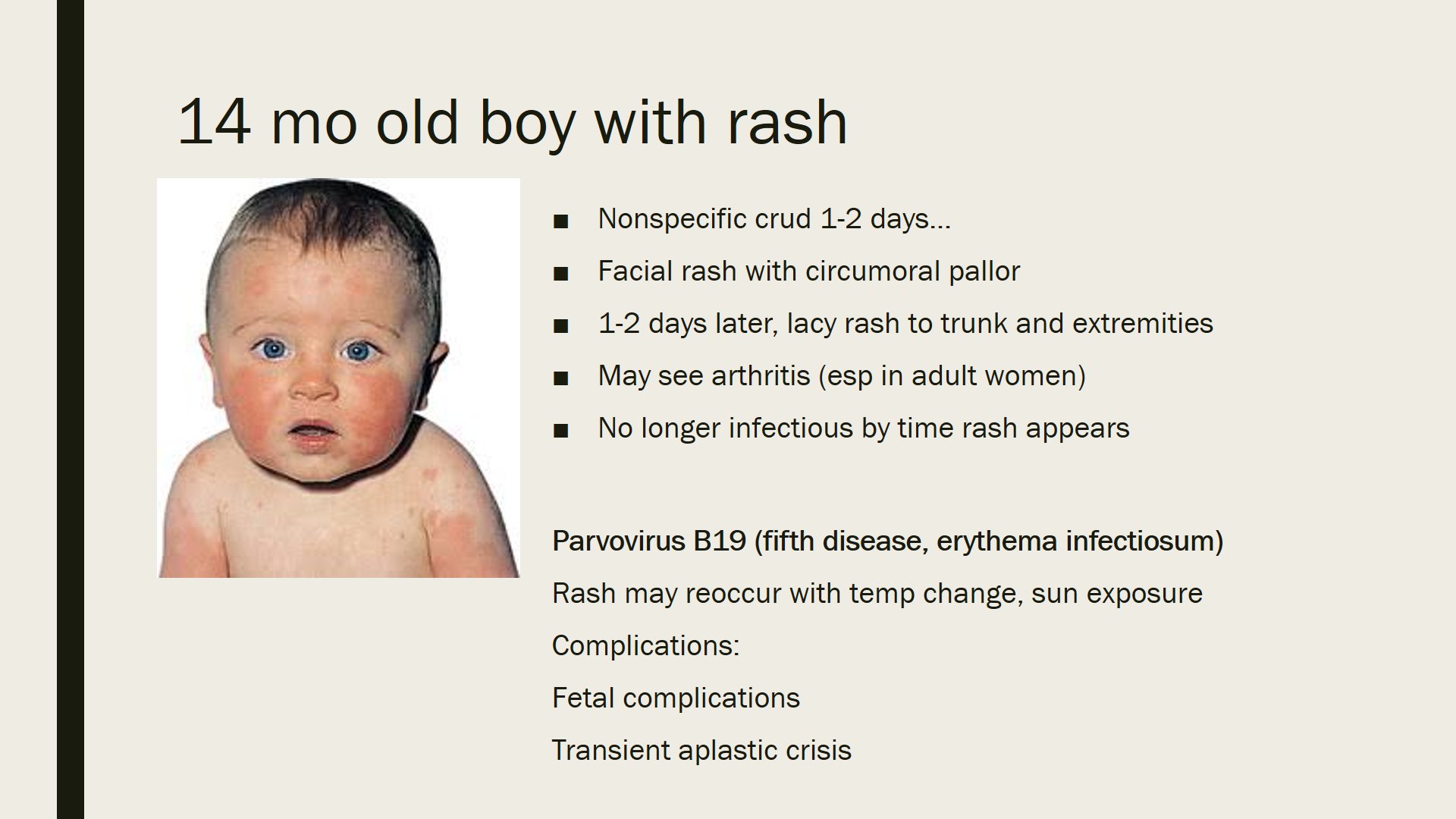 Erythema Infectiosum Lacy Rash