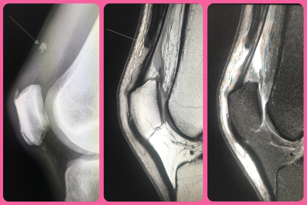 Quadriceps Tendon Calcification
