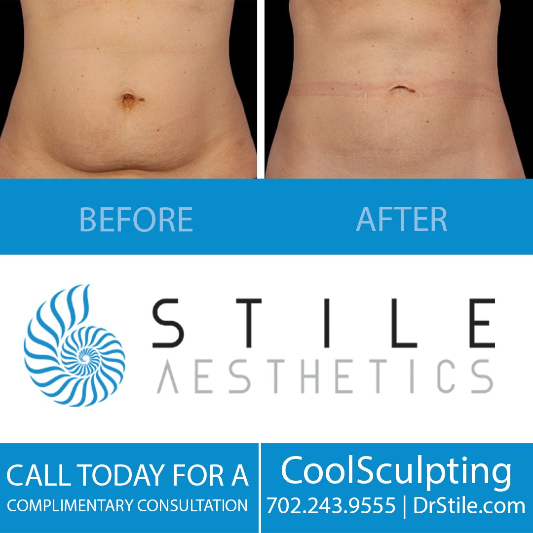 Frank Stile M D On Twitter Before And After Results From