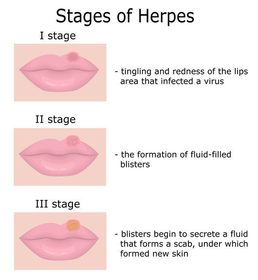 Fever Blister Stages