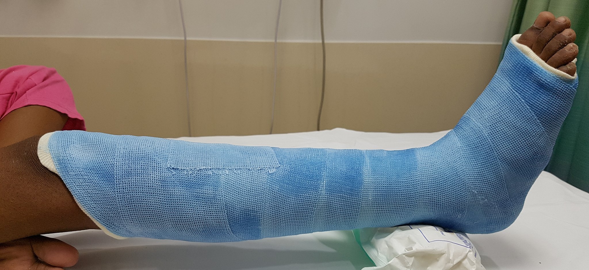 Patellar Tendon Bearing Cast