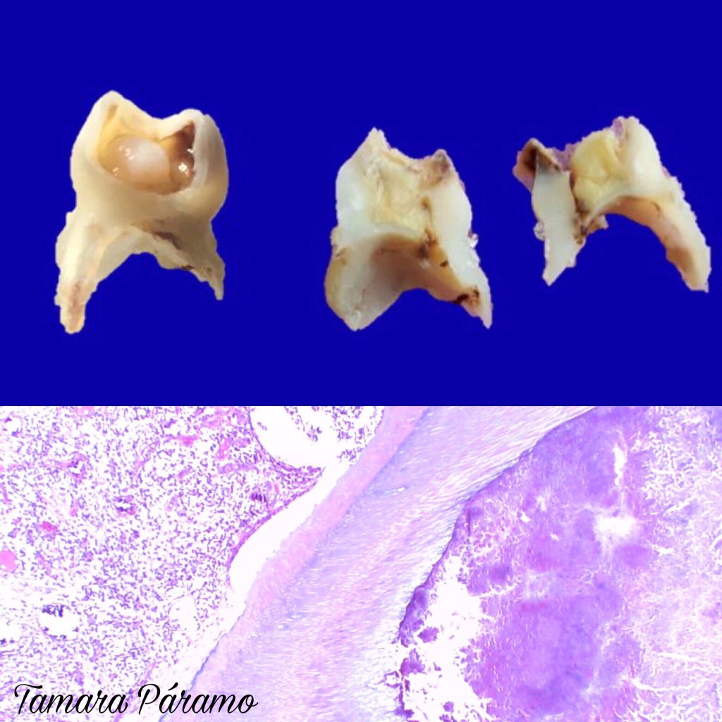 Chronic Hyperplastic Pulpitis
