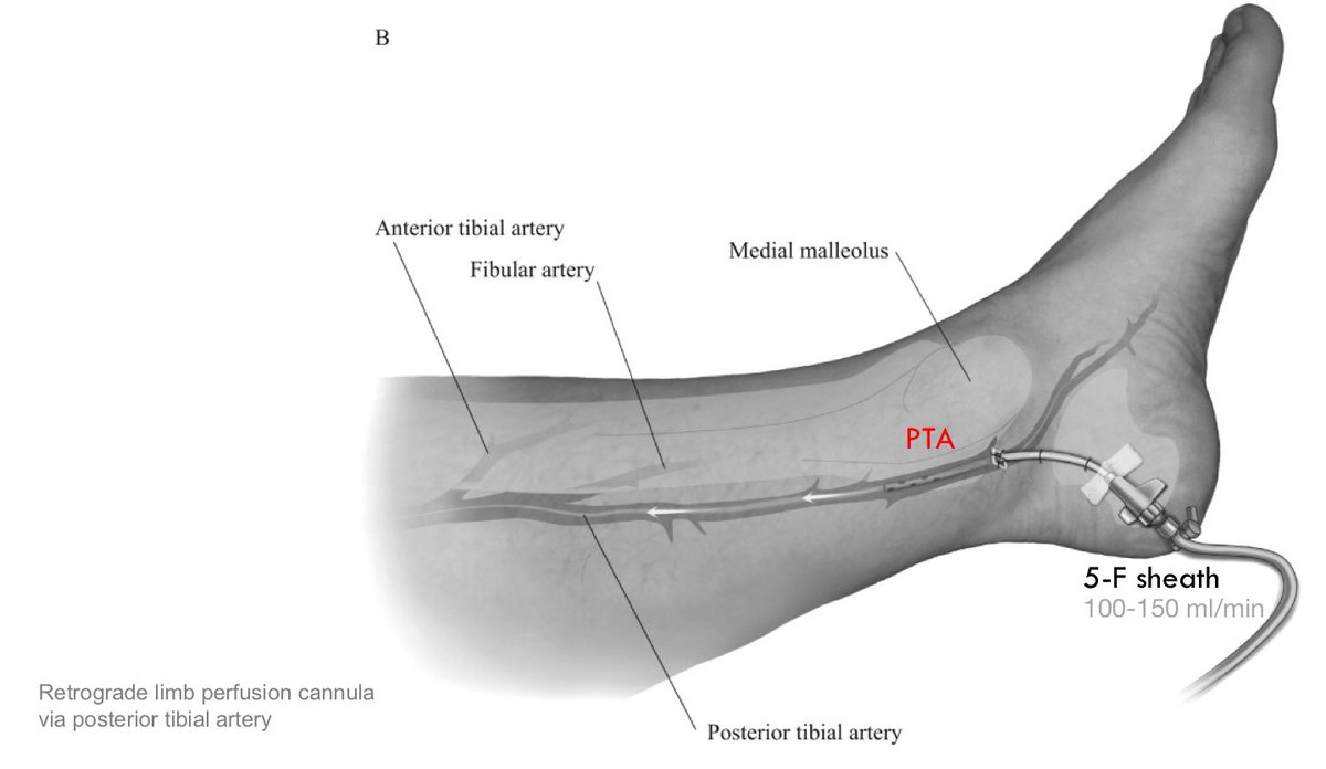 Posterior Tibialis Artery
